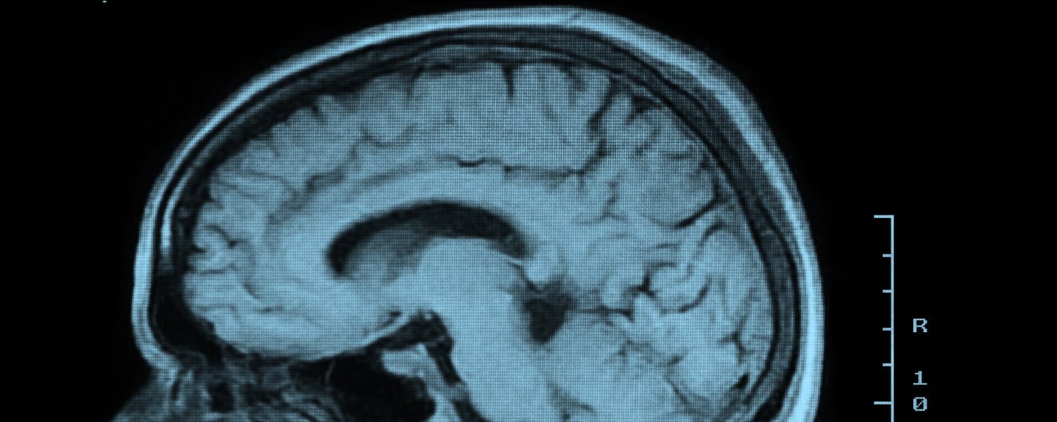 SPECT Testing For Traumatic Brain Injury